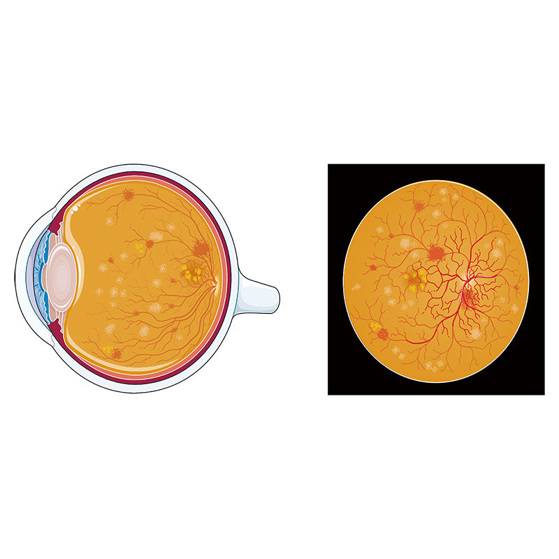 Diabetic retinopathy vector illustration Diabetic retinopathy vector illustration