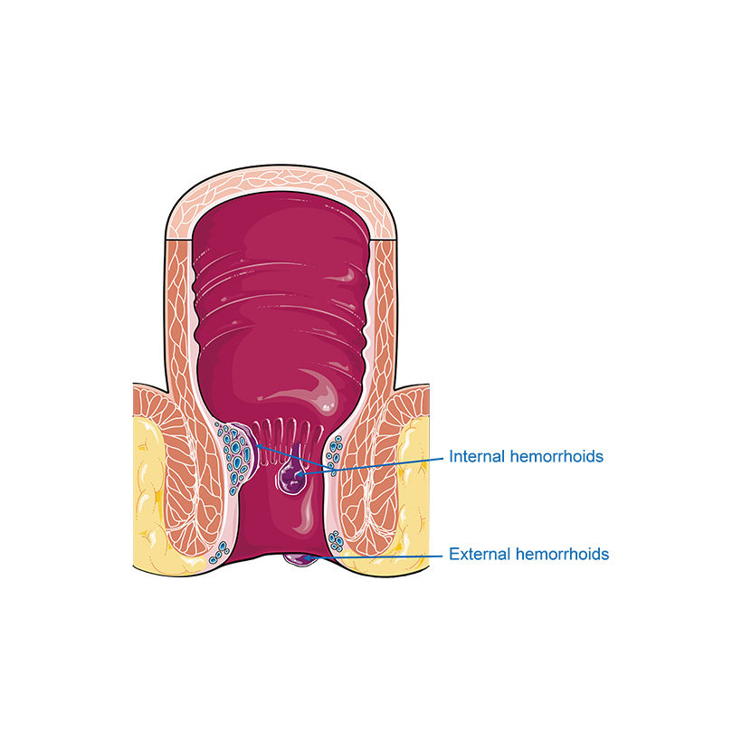 Hemorrhoids Vector