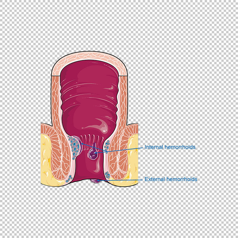 Hemorrhoids Vector